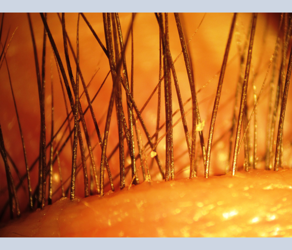Slit Lamp Series Demodex Mites Global Insight